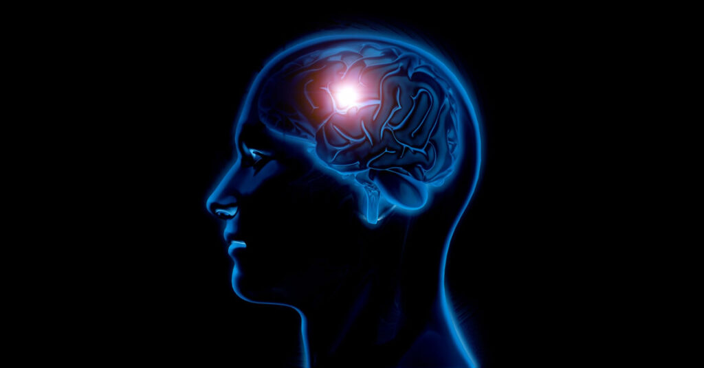 Smoldering Spots in the Brain May Signal Severe MS